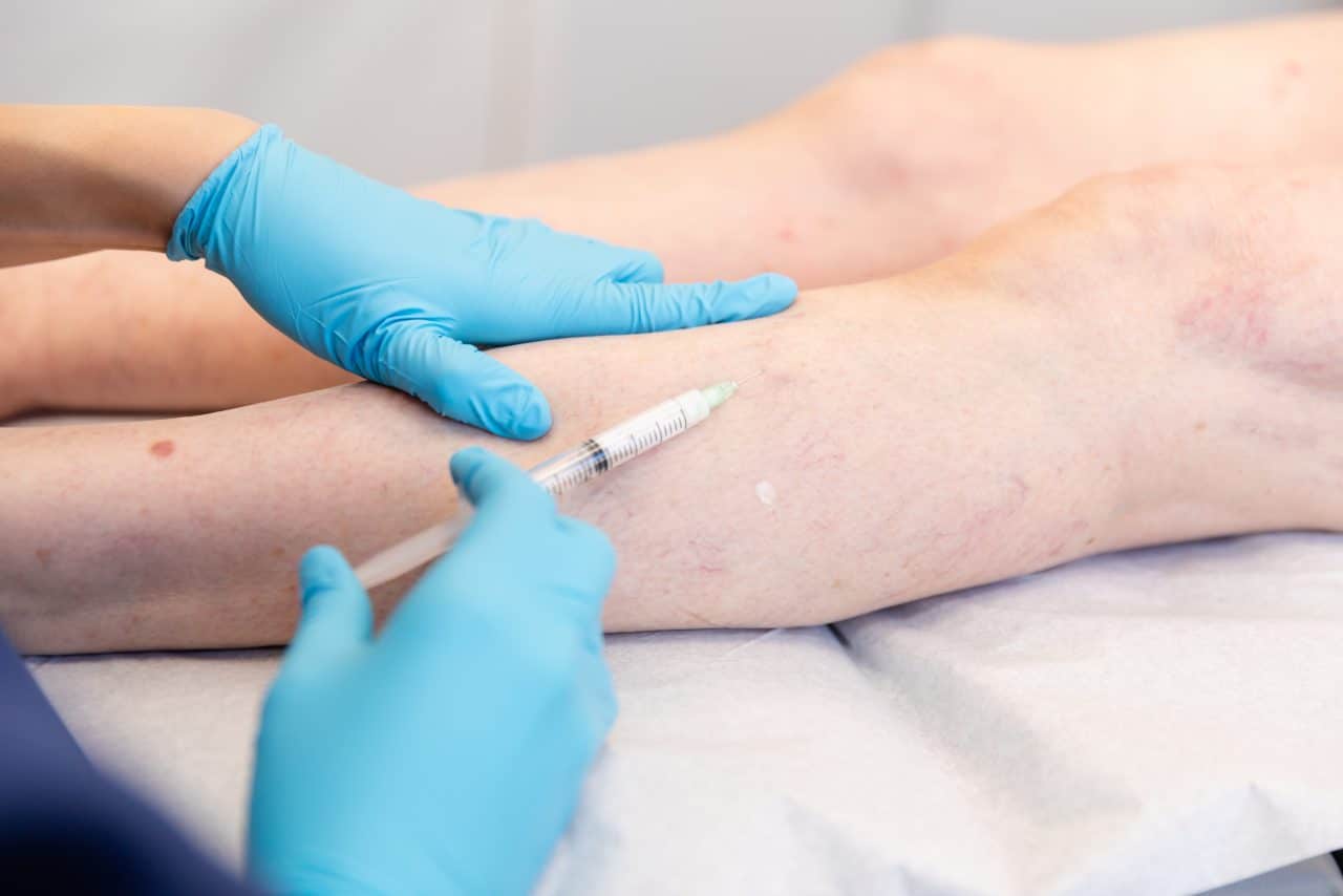 Sclerotherapy Vein Removal New York, NY | Laser Center