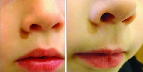 Cafe Au Lait Birthmark Removal New York, NY | Laser Center