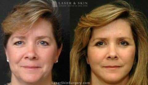 MACS Facelift Cosmetic Surgeon - Laser NY