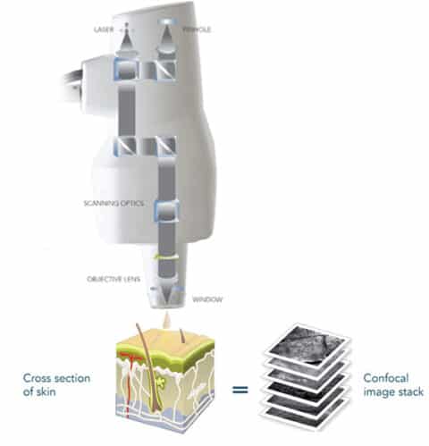 Skin Cancer Screening NYC - Laser NY