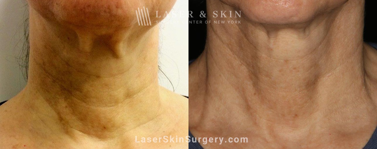 Before & After Photo Gallery New York, NY | Laser Center