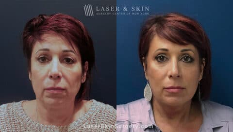 5 Best Procedures to Tighten Loose Skin Without Surgery - Laser NY