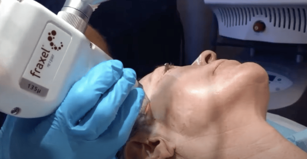 5 Best Procedures to Tighten Loose Skin Without Surgery - Laser NY