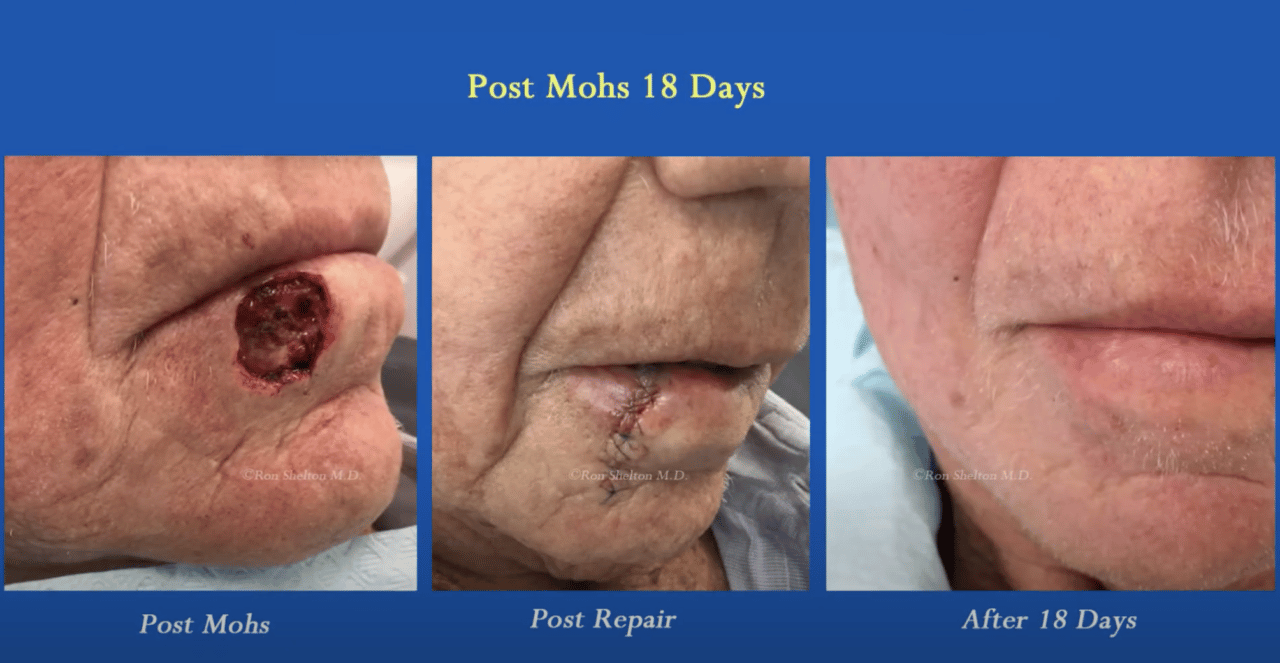 Mohs Skin Cancer Surgery New York, NY | Laser Center