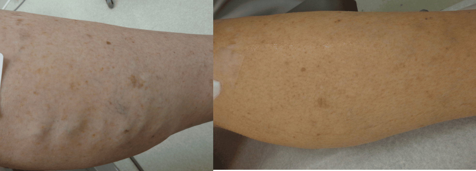 Sclerotherapy Vein Removal New York, NY | Laser Center