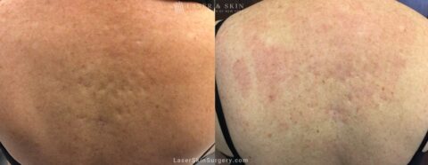 How to Treat Pitted Acne Scars and Boost Your Confidence - Laser NY