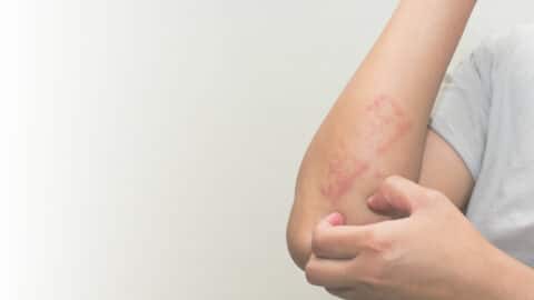 Pediatric Dermatology Overview New York, NY | Laser Center