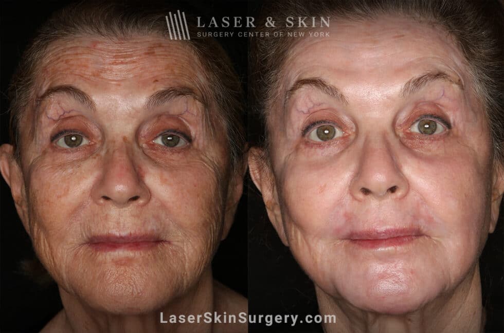 Laser & Device Showdown: A Comprehensive Comparison of Every Skin ...