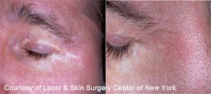 Hypopigmentation Skin Overview New York, NY | Laser Center
