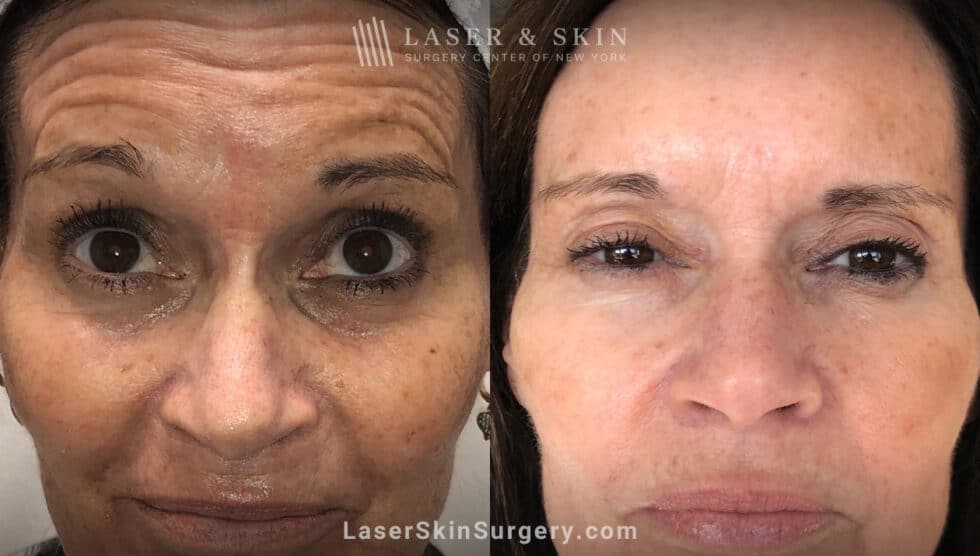 How to Correct Botched Botox? Dermatology Experts Explain - Laser NY