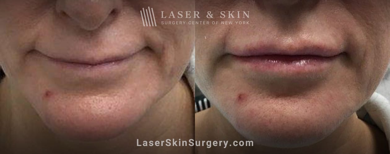 RHA filler for dynamic wrinkles New York, NY | Laser Center