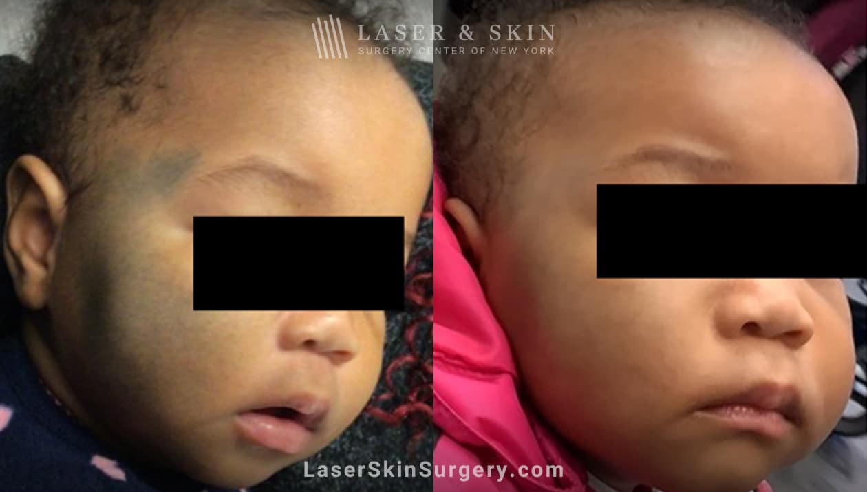 Laser Hyperpigmentation Removal New York, NY | Laser Center