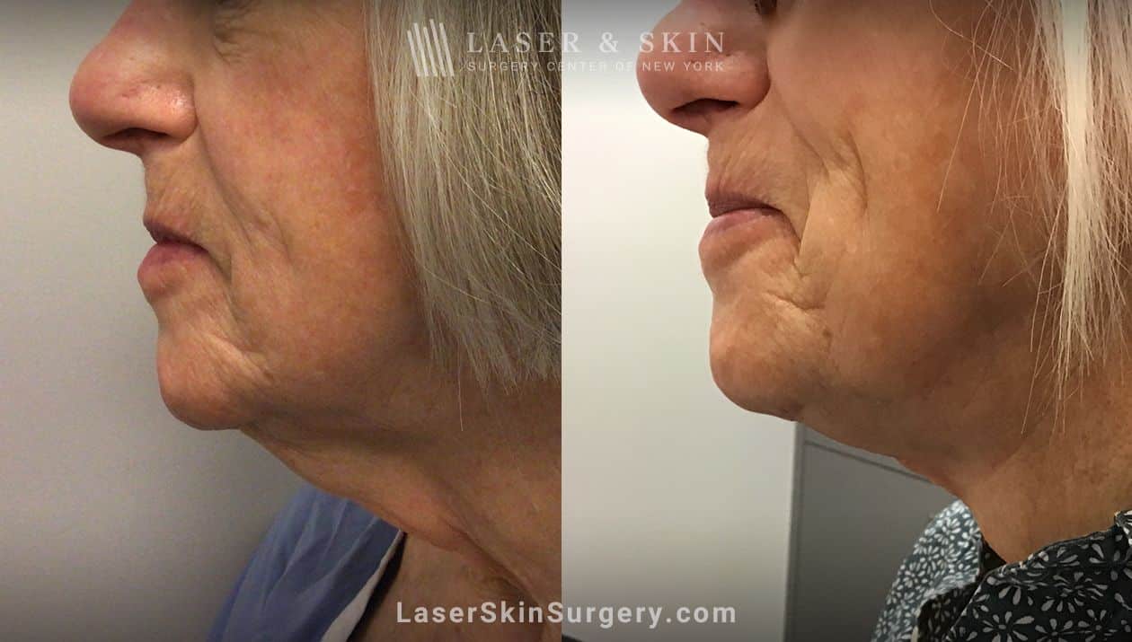 Before & After Photo Gallery New York, NY | Laser Center