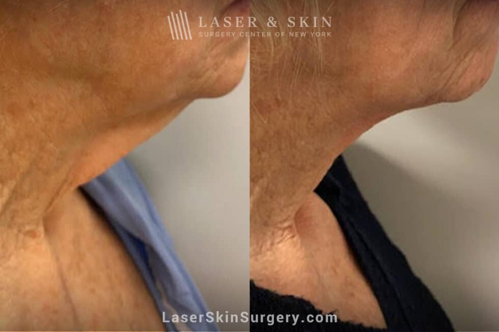 Does Botox work for neck sagging? Expert dermatologists reveal - Laser NY