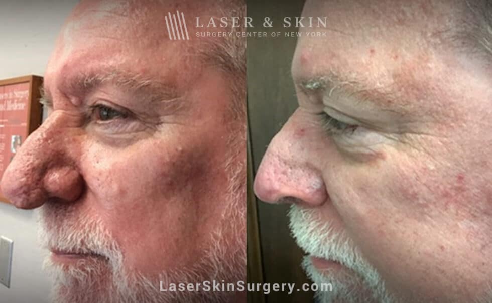 Rhinophyma Laser Treatment - Laser NY
