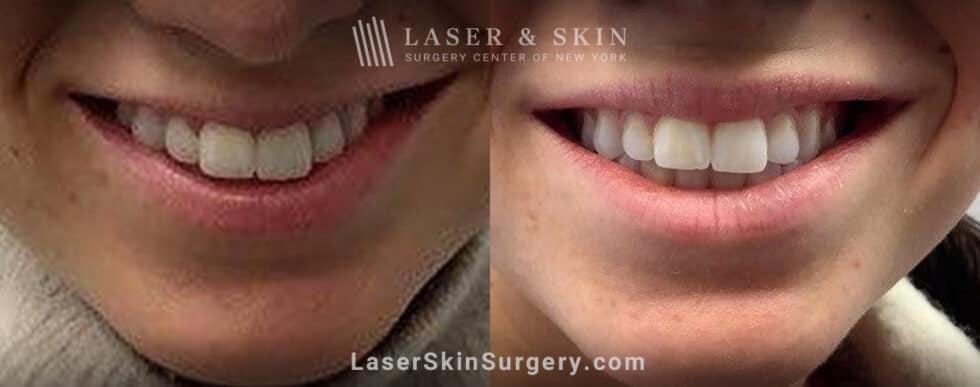 Is Lip Filler Migration Really a Thing? Dermatologists Explain - Laser NY