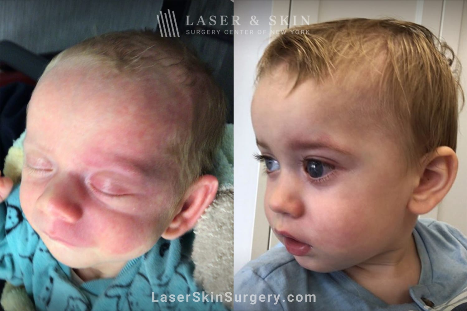 Vascular & Pigmented Birthmarks New York, NY | Laser Center