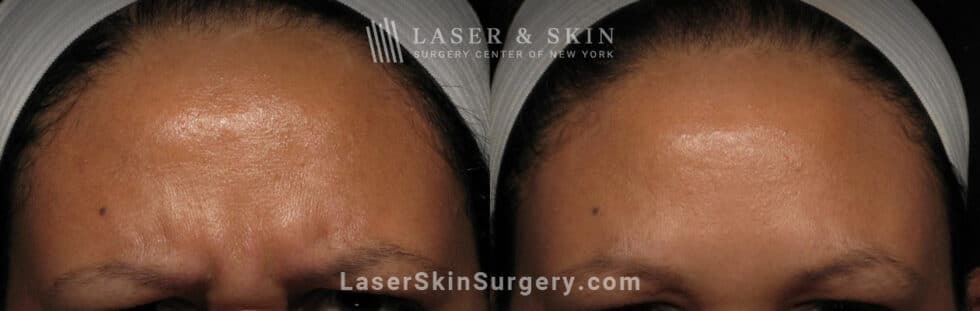 5 long-term effects of Botox you need to know - Laser NY