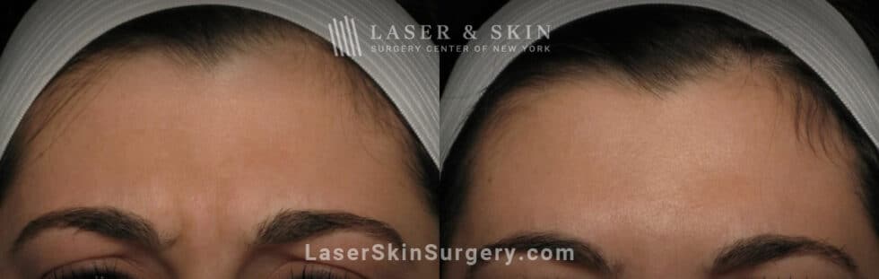 What Is Preventative Botox? - Laser NY