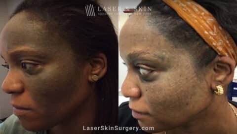 What Is Your Fitzpatrick Skin Type and How It Affects Your Skin? - Laser NY