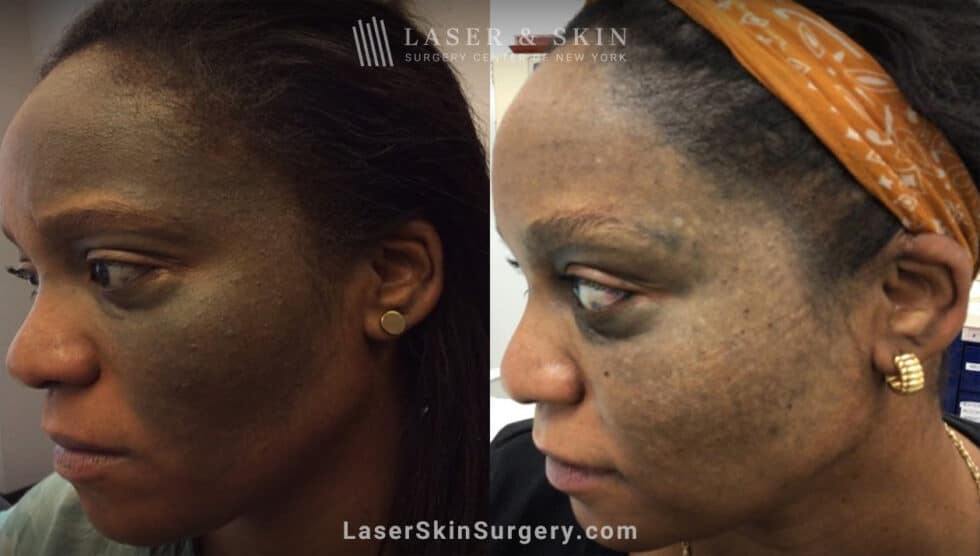 What Is Your Fitzpatrick Skin Type and How It Affects Your Skin? - Laser NY