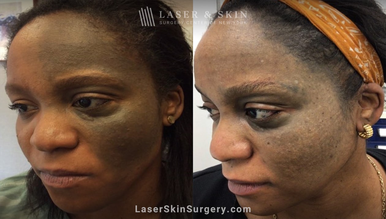 Freckle Treatment in New York - Laser NY