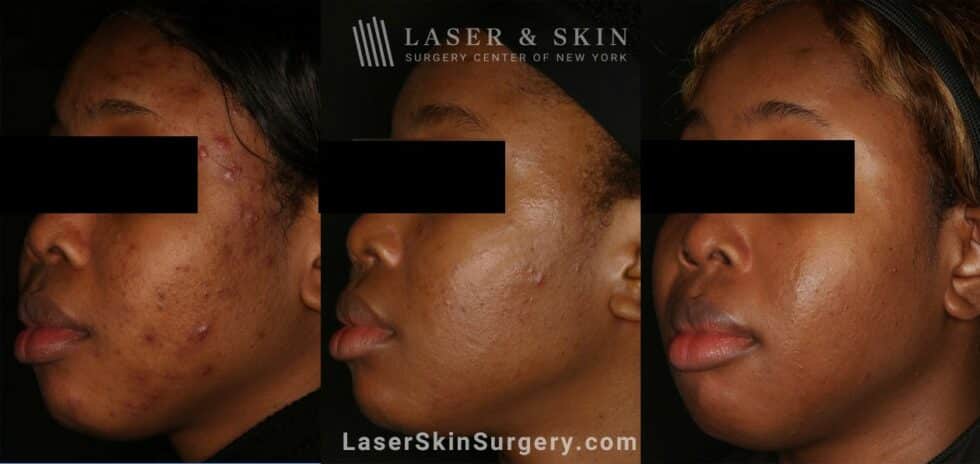 Acne Scars Treatment in New York - Laser NY