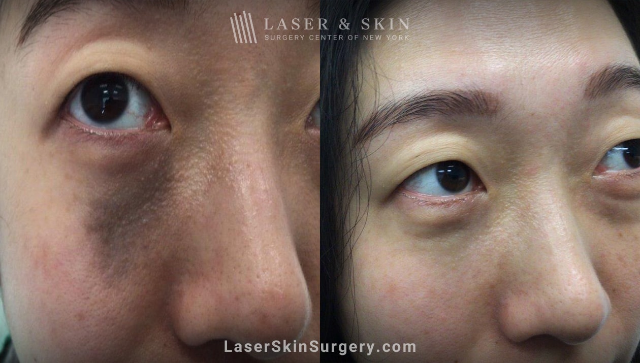 Freckle Treatment in New York - Laser NY