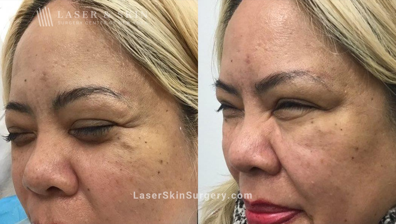 Wrinkle & Fine Lines Treatment New York, NY | Laser Center