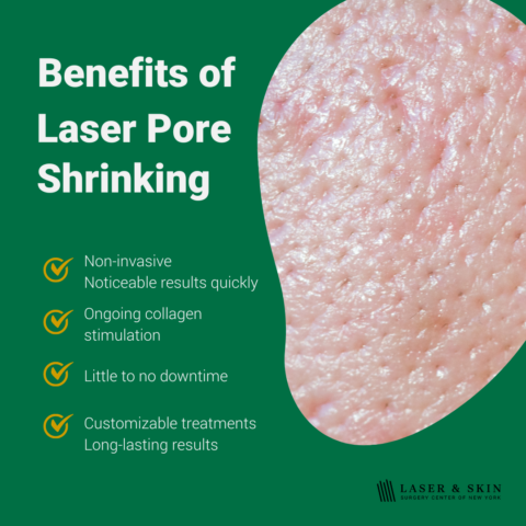 The Ultimate Guide to Laser Treatment for Shrinking Pores - Laser NY