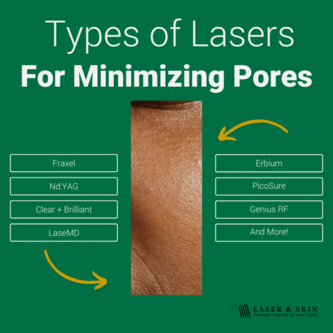 The Ultimate Guide to Laser Treatment for Shrinking Pores - Laser NY