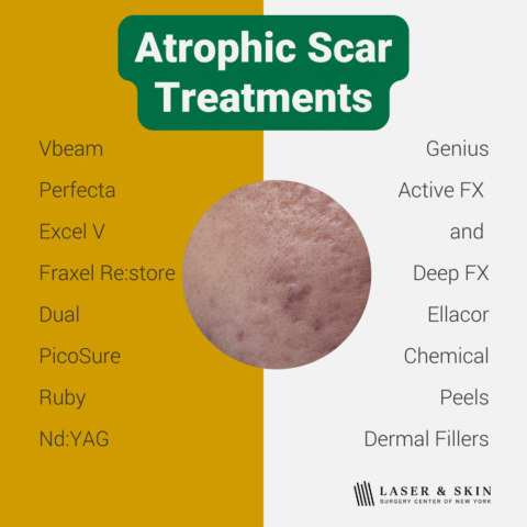 Best treatments for all types of scars explained - Laser NY