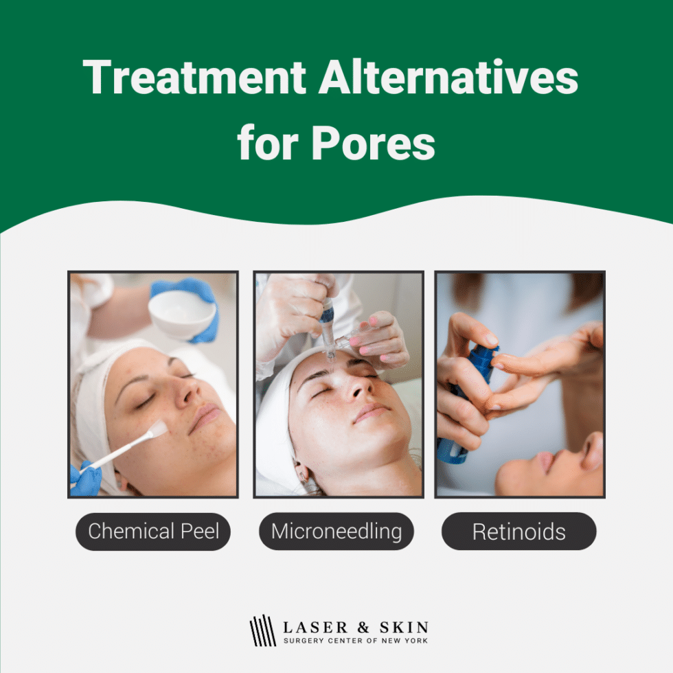 The Ultimate Guide to Laser Treatment for Shrinking Pores - Laser NY