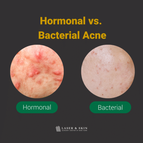 Is your acne hormonal or bacterial? Expert dermatologists share - Laser NY
