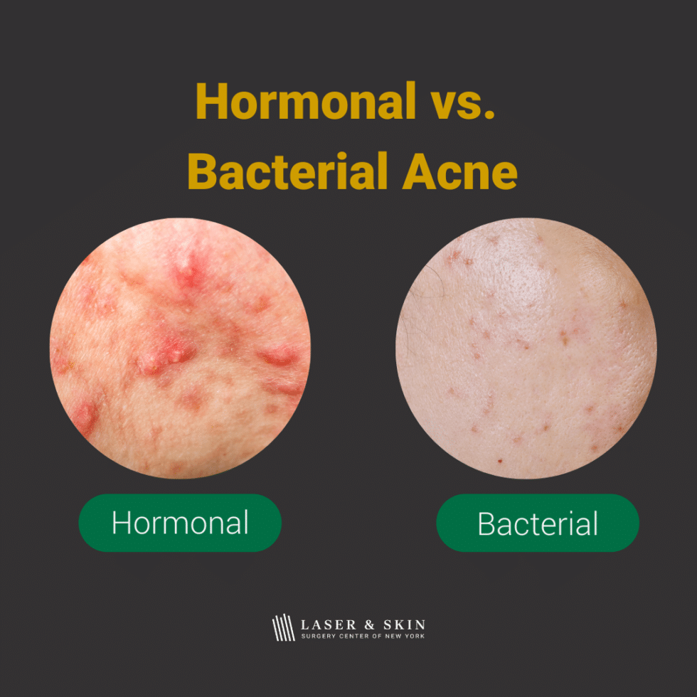 Is your acne hormonal or bacterial? Expert dermatologists share - Laser NY