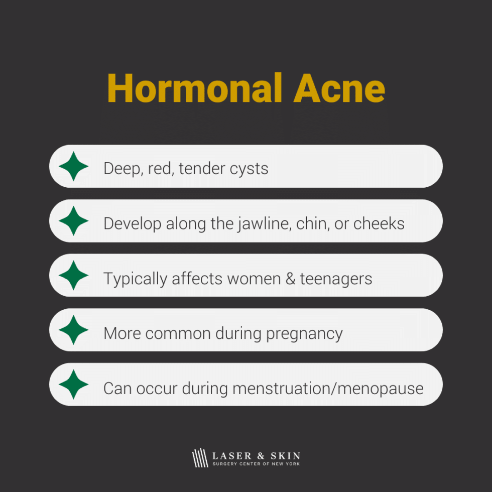 Is your acne hormonal or bacterial? Expert dermatologists share - Laser NY
