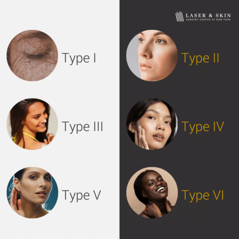 What Is Your Fitzpatrick Skin Type and How It Affects Your Skin? - Laser NY