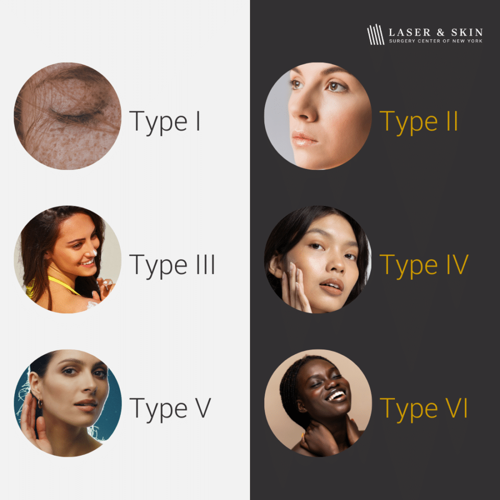 What Is Your Fitzpatrick Skin Type and How It Affects Your Skin? - Laser NY