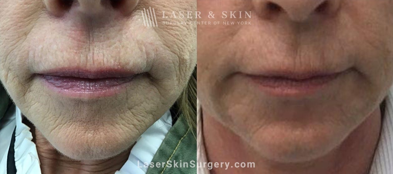 Sculptra Volume Enhancing Filler New York, NY | Laser Center