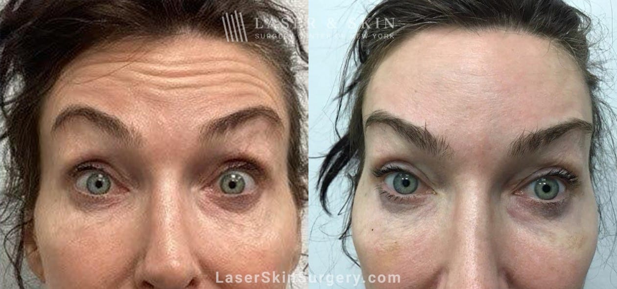 Mohs Surgery Before After Photos - Laser NY