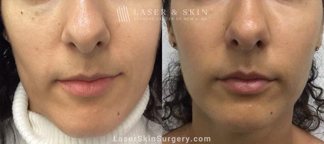 Sagging & Loose Skin Overview New York, NY | Laser Center