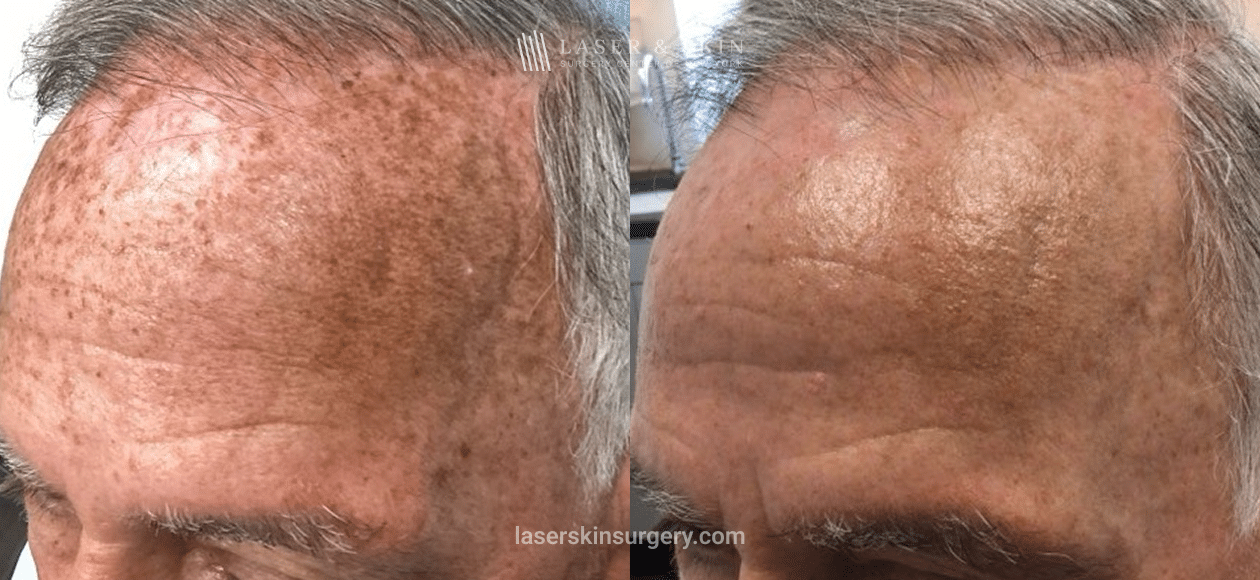 Mohs Surgery Before After Photos - Laser NY